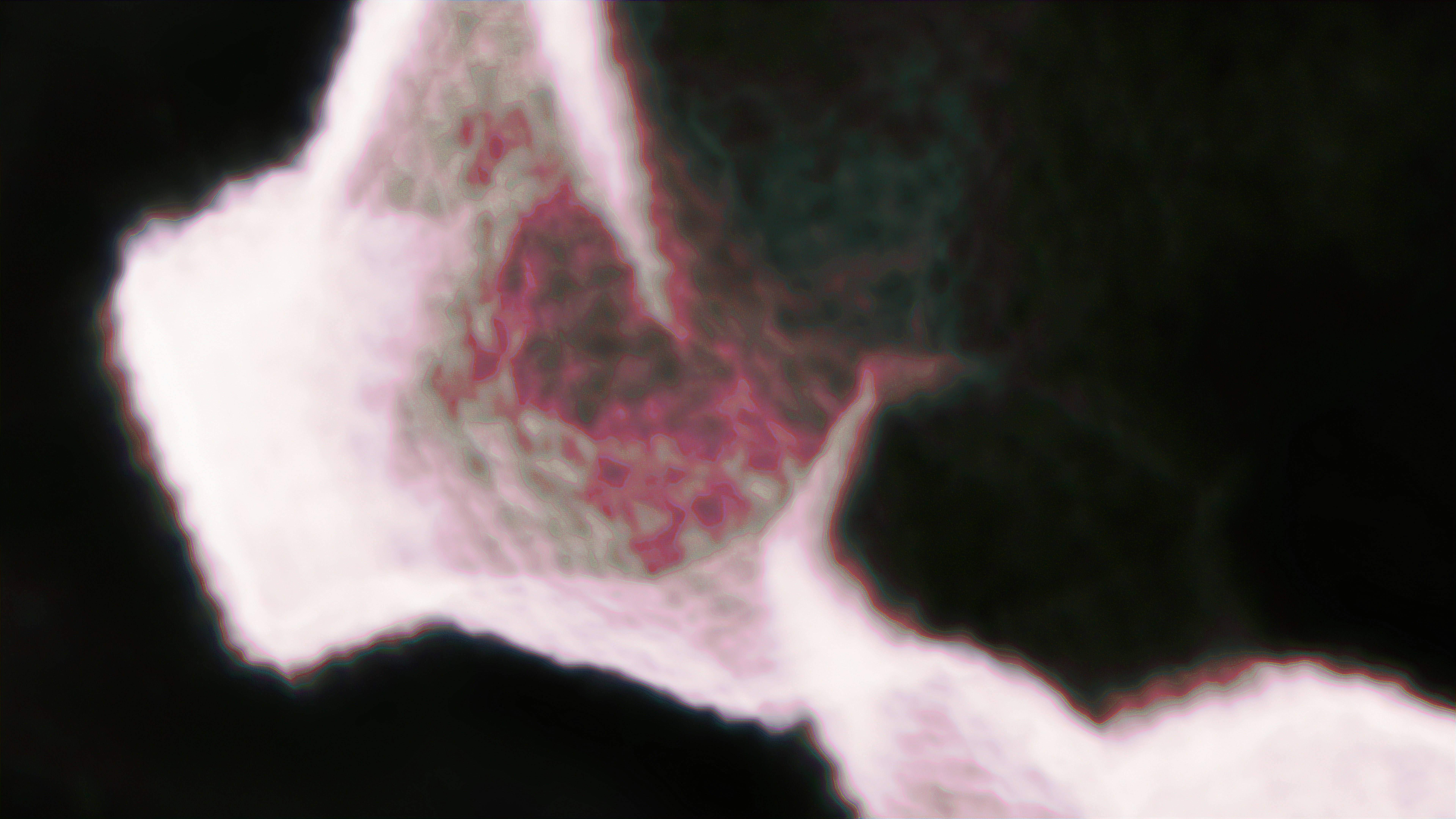 How Do Breast Implants Rupture: 4 Critical Risks