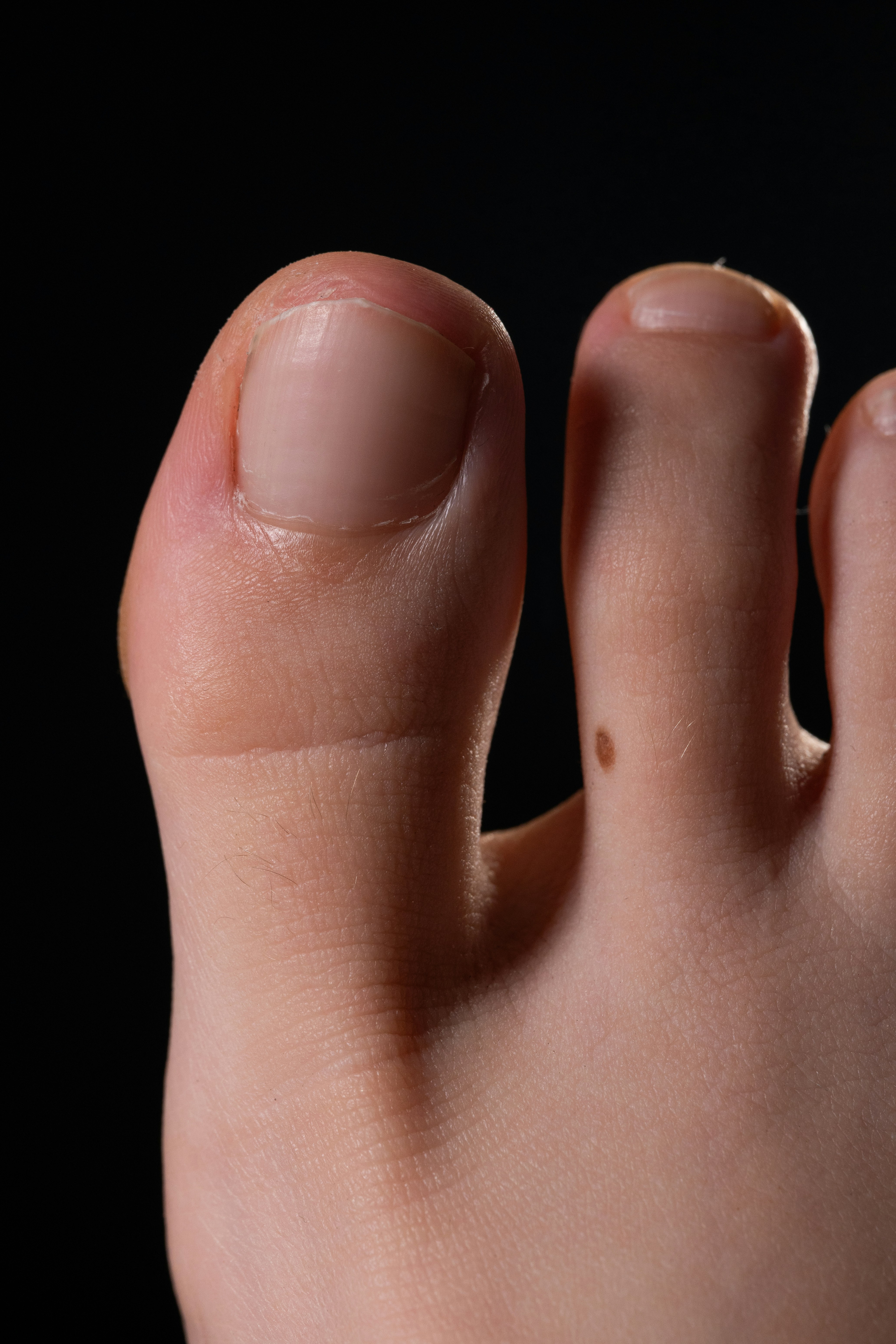 A close-up shot of a bare toe against a deep black background, emphasizing skin texture and nail detail without context.